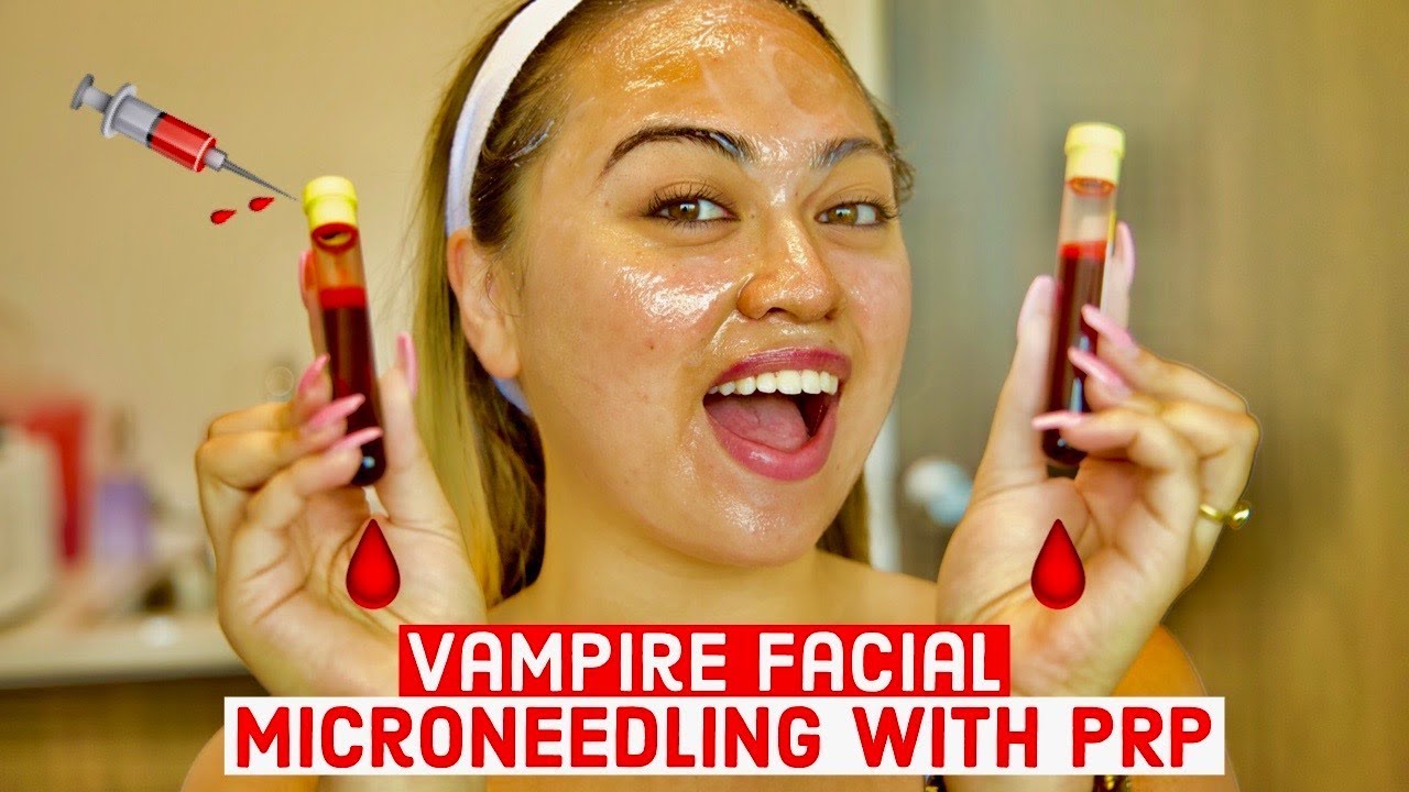 🧛🏼‍♀️💉VAMPIRE FACIAL!!!💉🧛🏼‍♀️MICRONEEDLING PRP Vlog | BONUS TIPS for ...