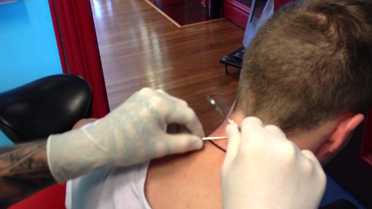 Nape Dermal Anchor - YouTube
