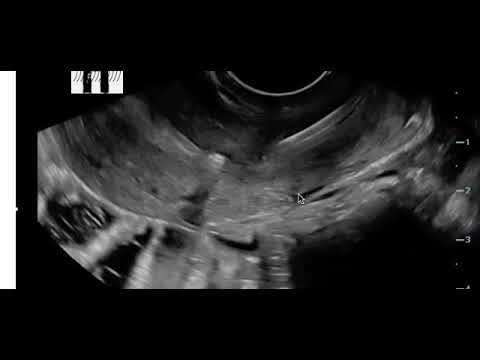 IUD on ultrasound - Jefferson hospital - YouTube
