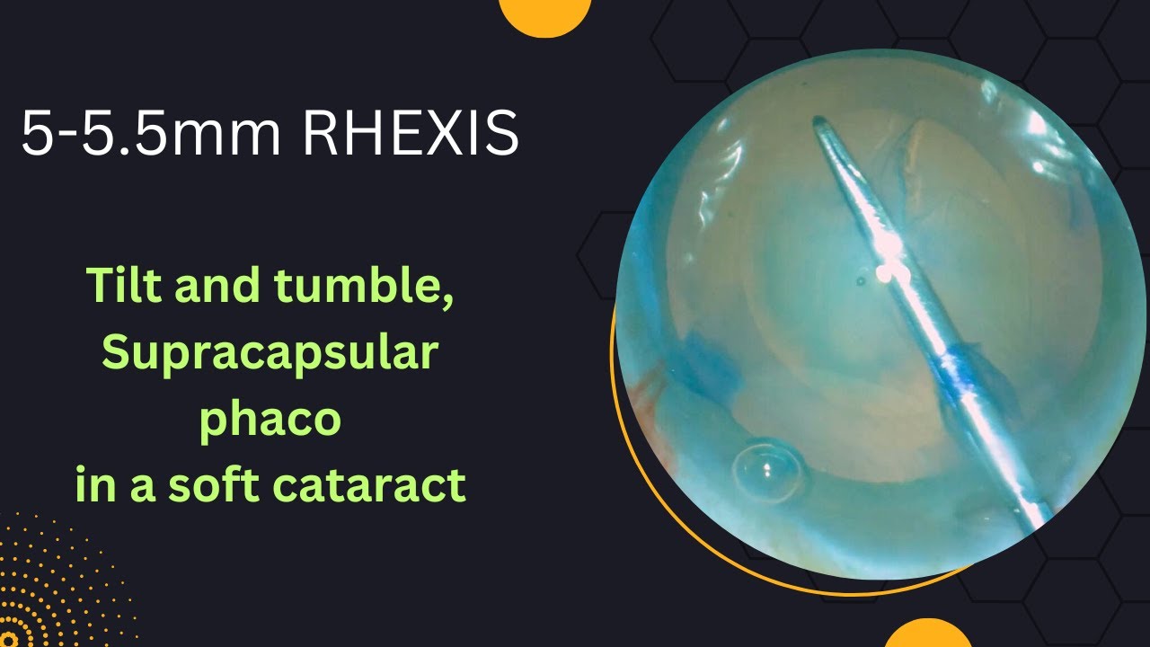 Case series 65. Rhexis 5-5.5mm Tilt and tumble supracapsular phaco in a ...