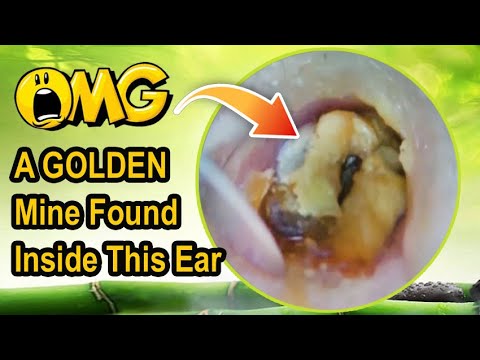 A GOLDEN Mine Found Inside This Ear Remove With Sound Relaxing - YouTube