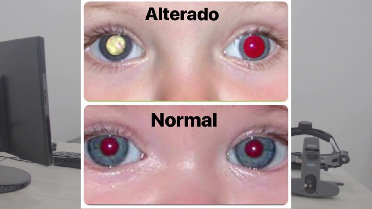 Patologías oculares leucocoria - YouTube