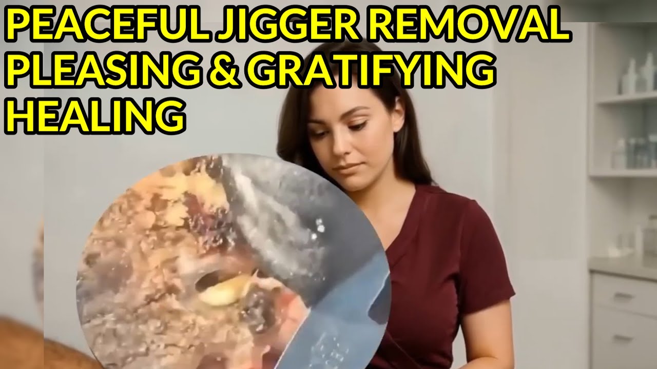 Peaceful Jigger Removal | Pleasing & Gratifying Healing - YouTube