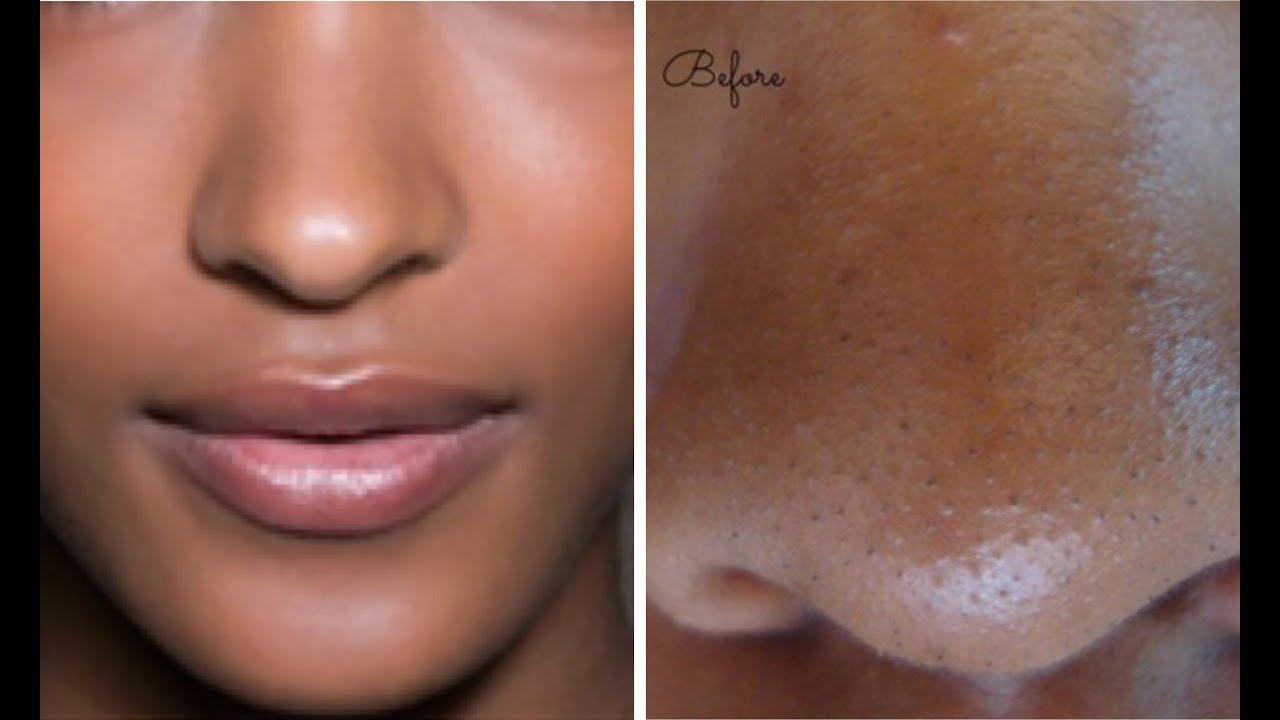 Tu faira ceci pour te débarrasser des milliers des points Noirs sur le ...