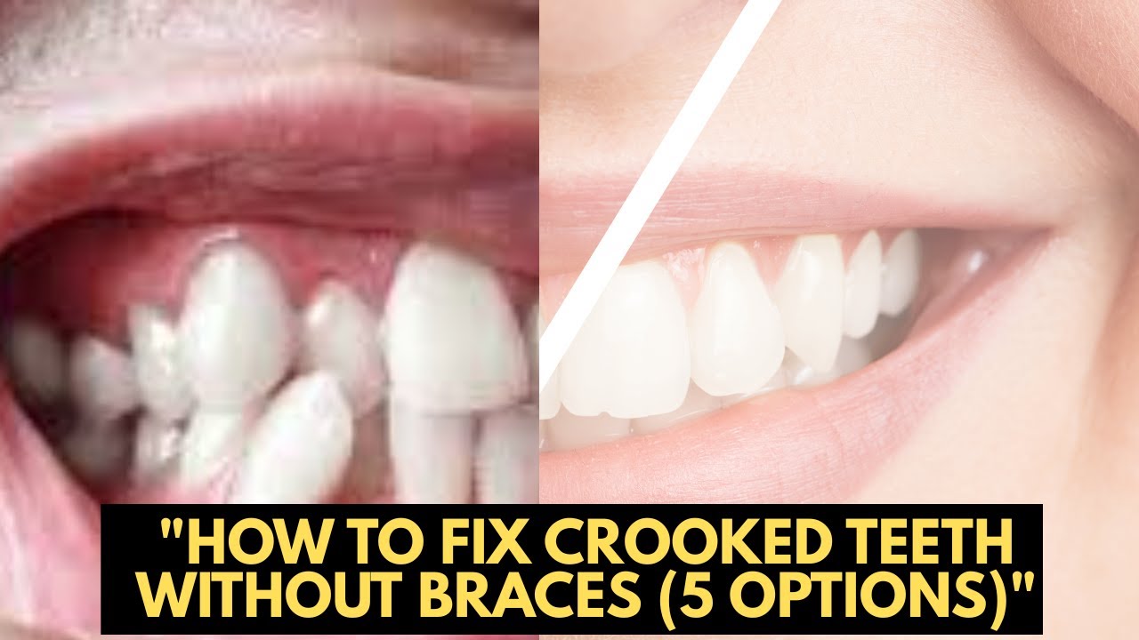 How to Fix Crooked Teeth Without Braces | Top 5 Proven Options for ...