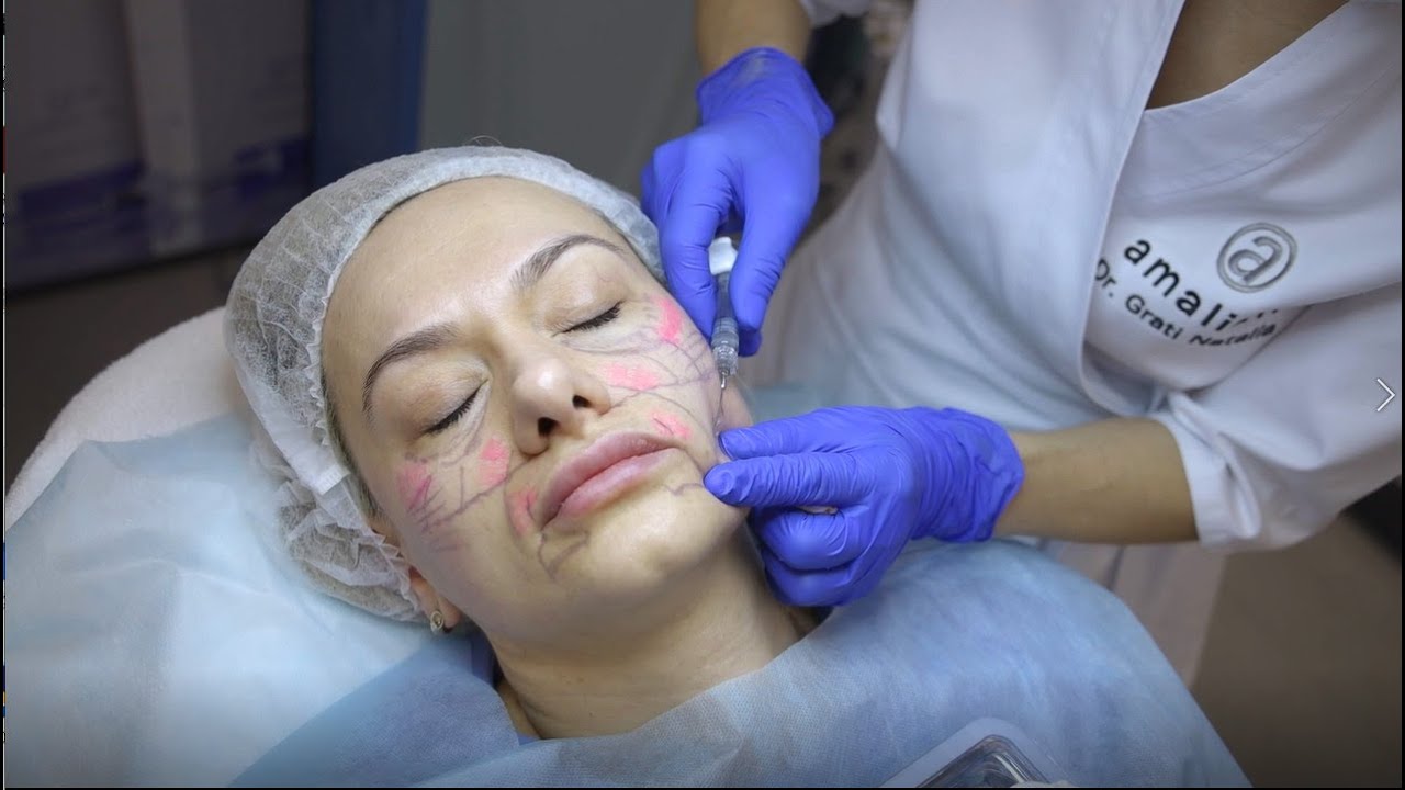 Practical presentation of monophasic hyaluronic acid fillers AMALIAN ...