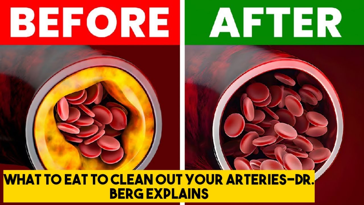 What to Eat to Clean Out Your Arteries—Dr. Berg Explains | Wikiaware ...