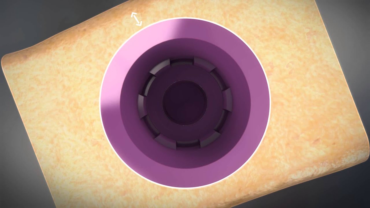 V3 MIS Implant - YouTube