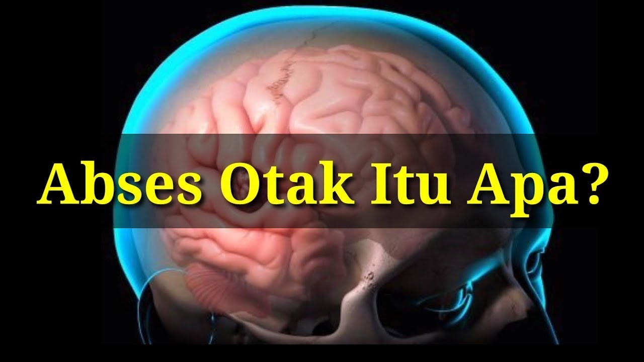 Abses Otak - Pengertian, Gejala, Penyebab, Faktor Risiko . - YouTube