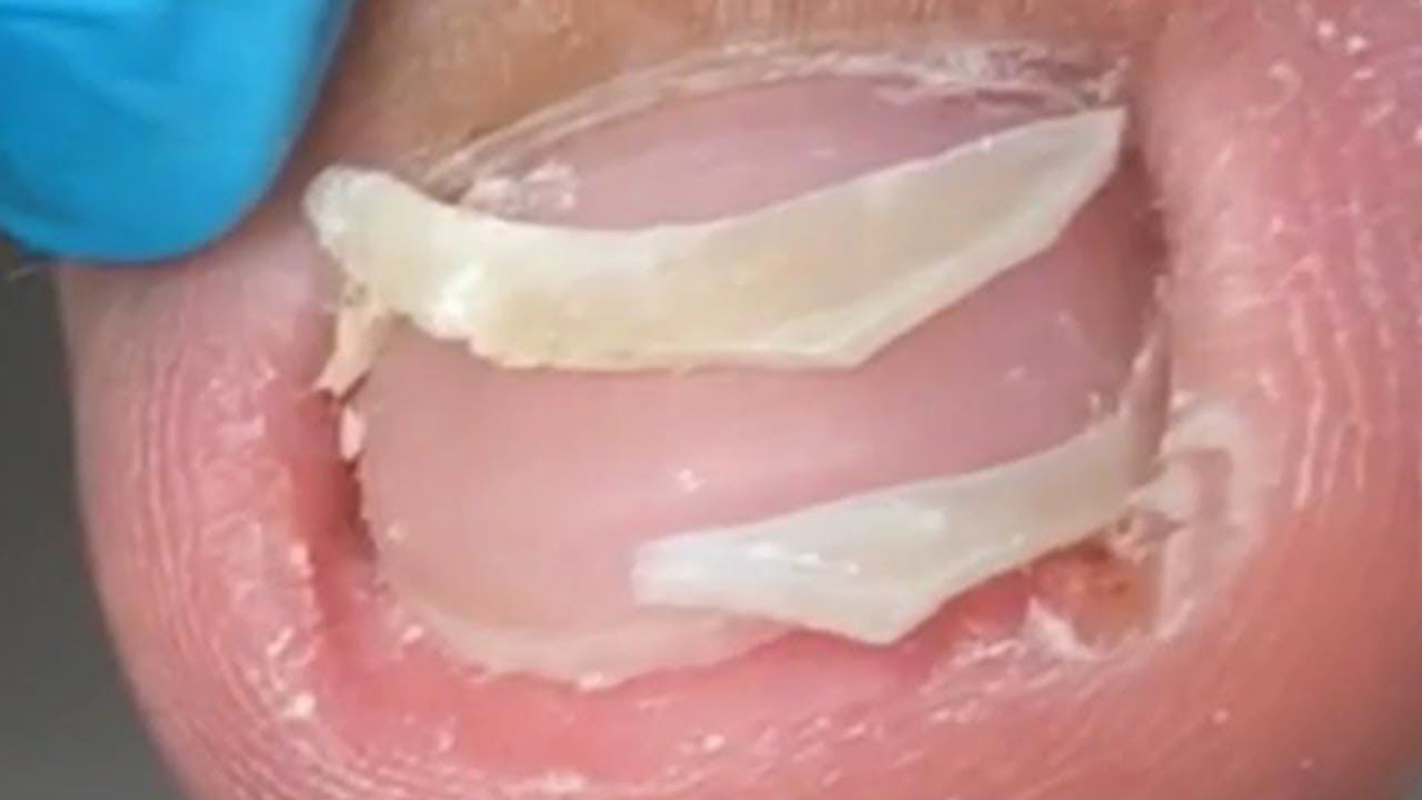 Easily trim two ingrown toenails, very stress relieving【Crazy pedicure ...