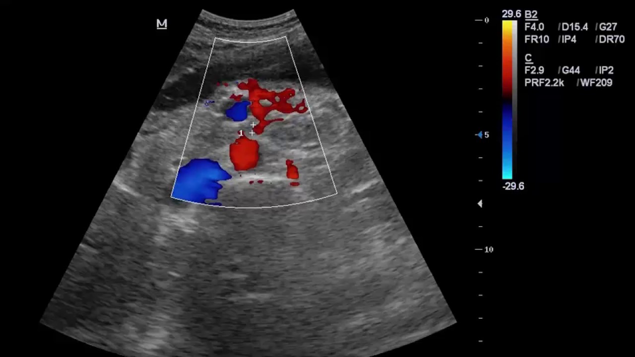 CASE 271 SUPERIOR MESENTERIC ARTERY SYNDROME SMAS - YouTube