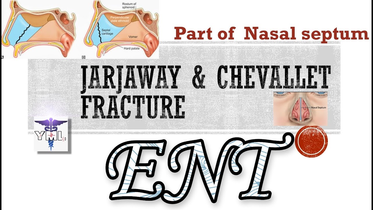 Jarjaway & chevallet fracture — Part of Nasal Septum - YouTube