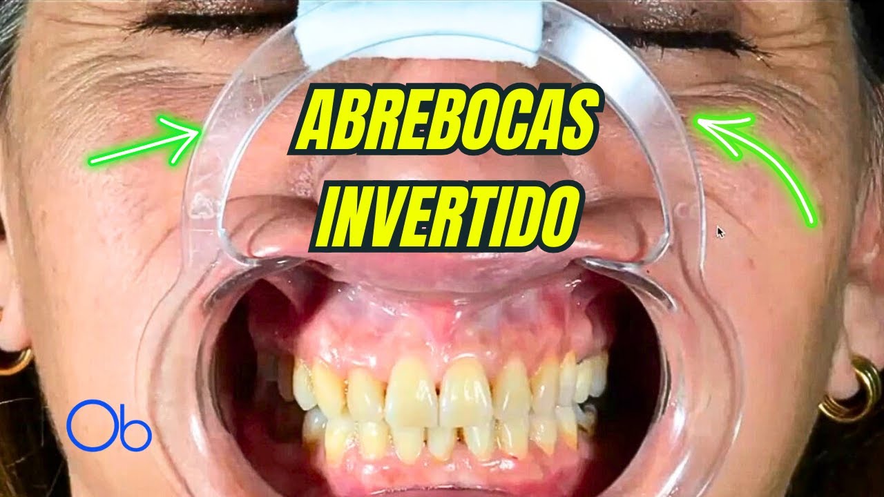 Abrebocas Invertido 🙃 en Blanqueamiento Dental - YouTube