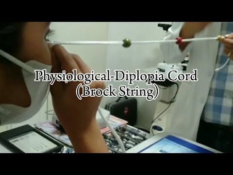 Physiological-Diplopia Cord (Brock String)