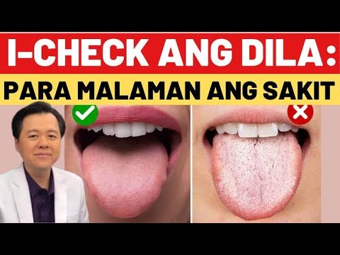 I-check ang Dila Para Malaman ang Sakit. - By Doc Willie Ong (Internist and Cardiologist) - YouTube