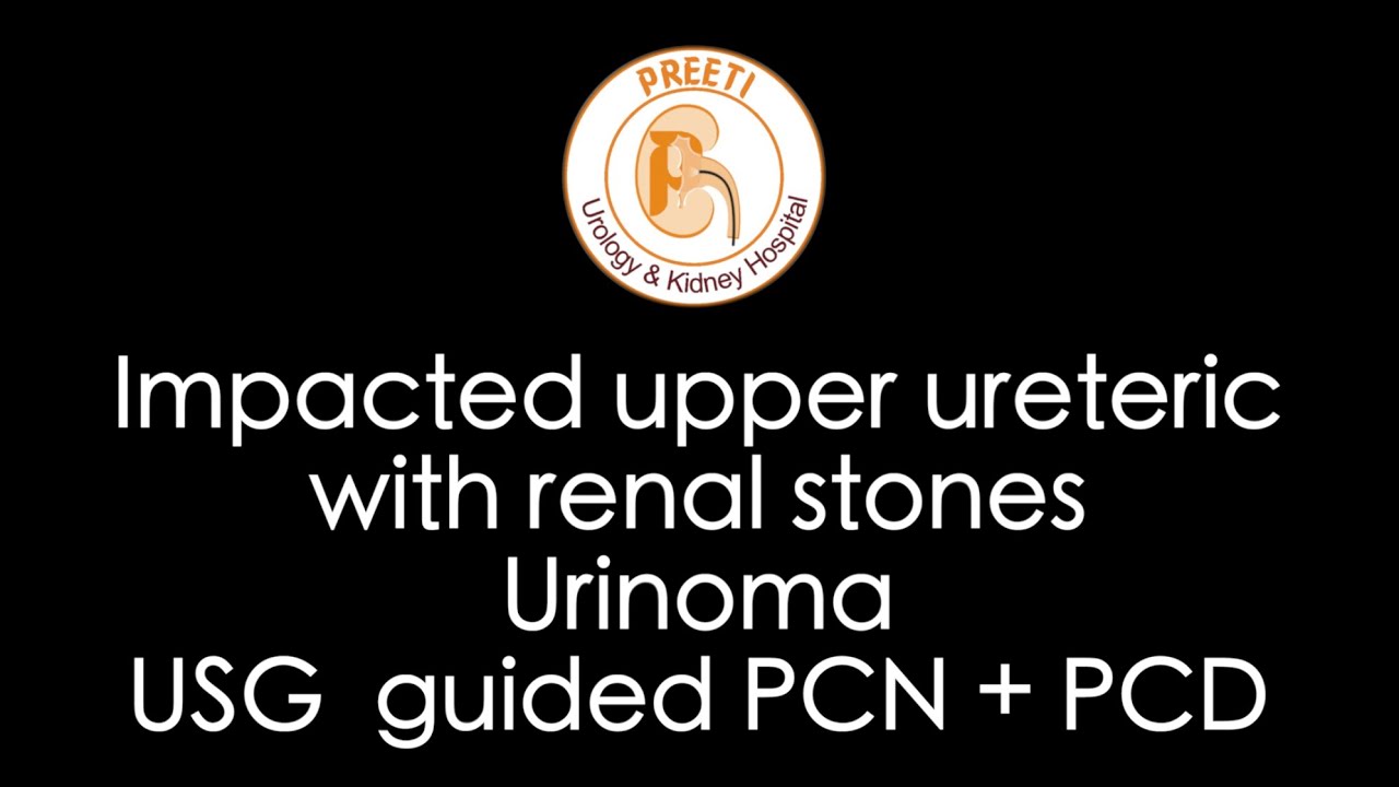 Impacted upper ureteric with renal stones - Urinoma - USG guided PCN ...