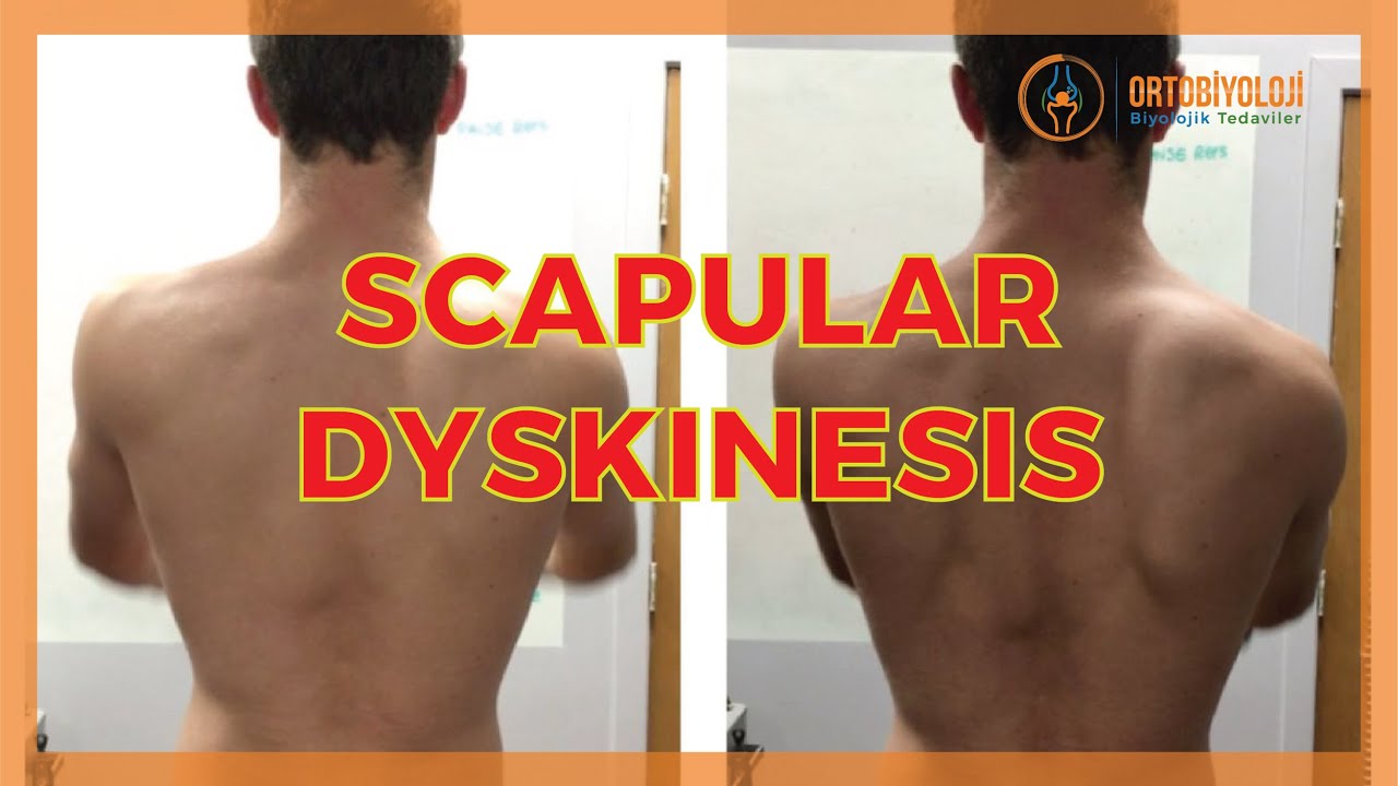 SCAPULAR DYSKINESIA - YouTube