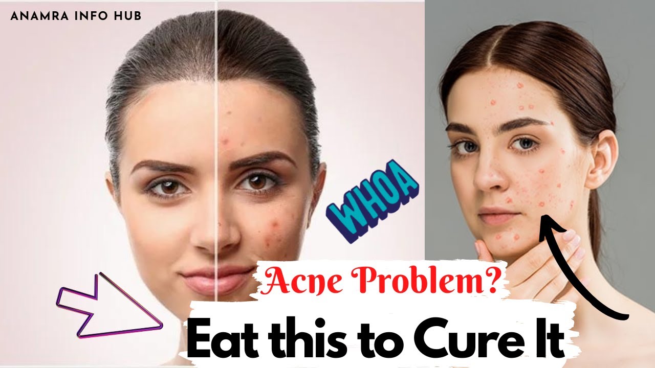 What is Acne | How Acne occurs | Foods To Eat To Prevent Acne | What ...
