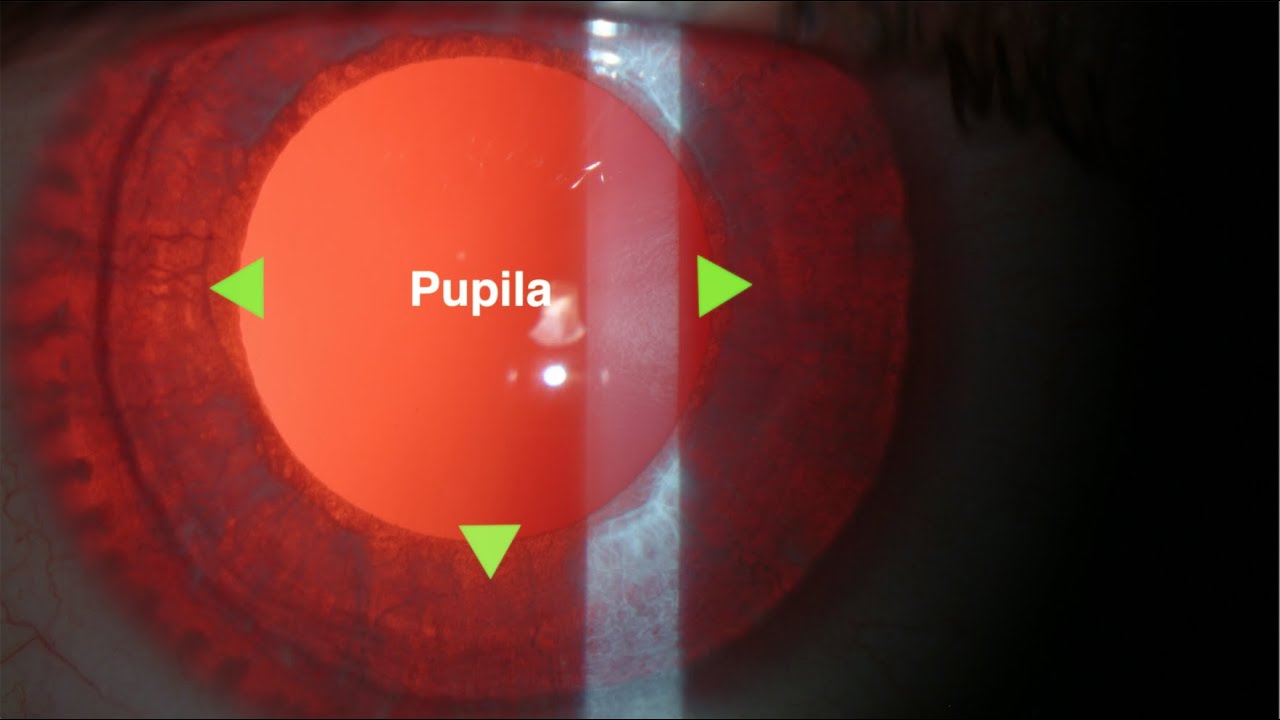 El color de los ojos: ojos albinos y ojos azules - YouTube