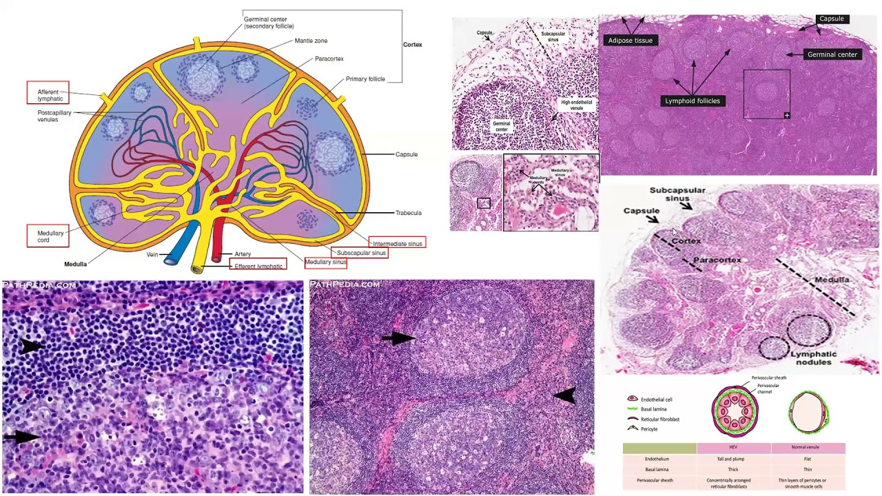 Pathology Made Easy-Systemic Pathology 8-Blood Diseases-5 - YouTube