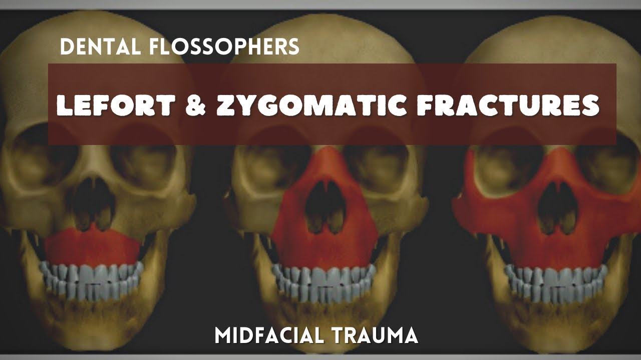 MIDFACIAL FRACTURES || LEFORT FRACTURES || ZYGOMATIC FRACTURES ...