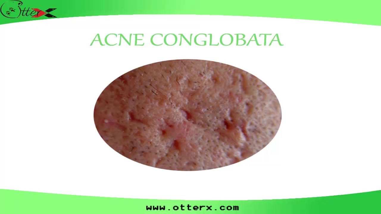 Acne Conglobata - YouTube