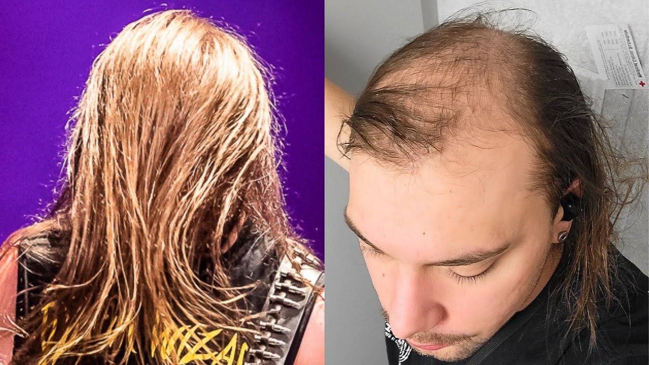 FRONTMAN TELLS ALL On Losing His Hair *BALDING* - YouTube