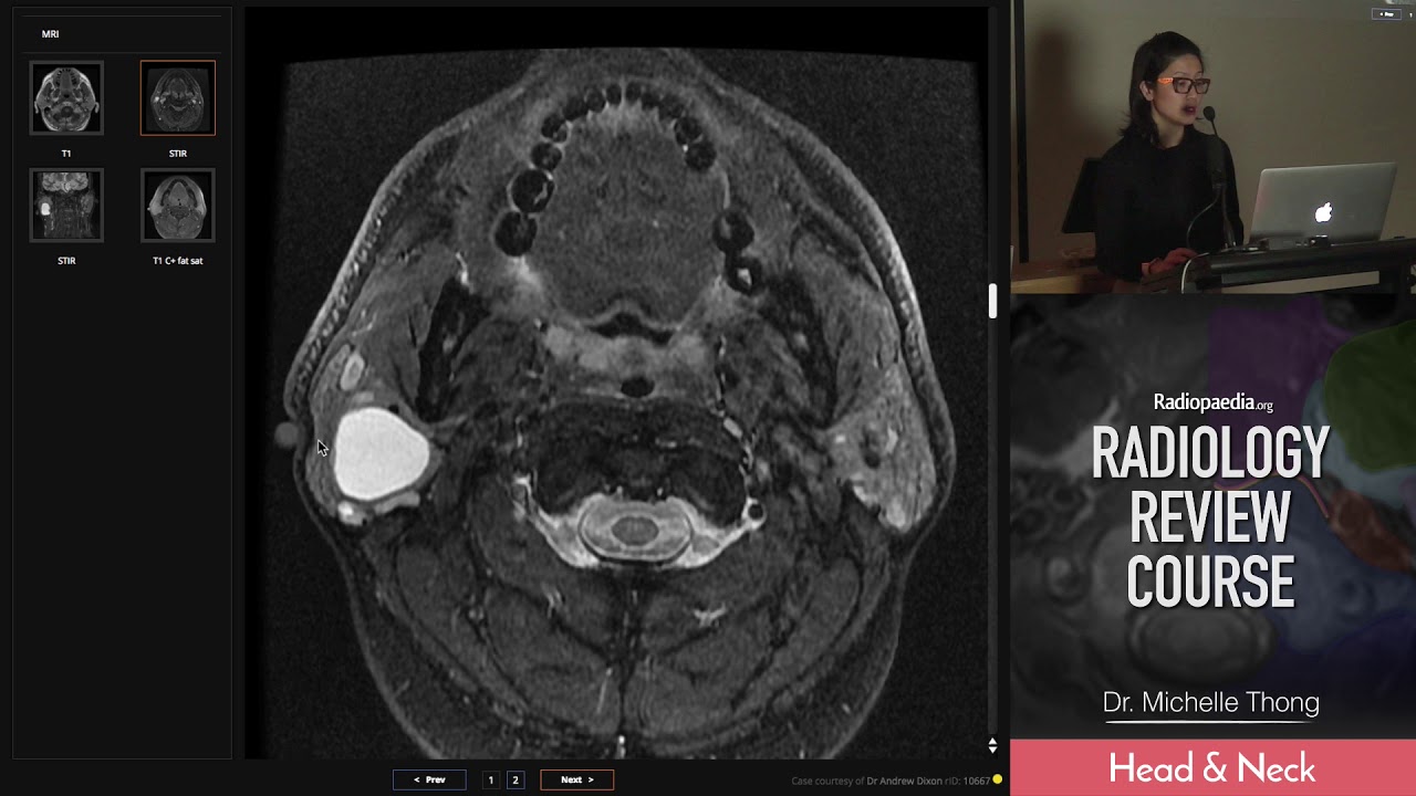 Bilateral Parotid Diseases Radiology Review Course Mri Ct Ultrasound Youtube