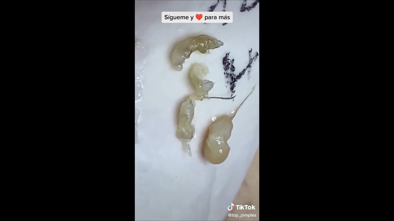 TINY Blackheads Extracted (Blackheads Removal Videos 2023) - YouTube
