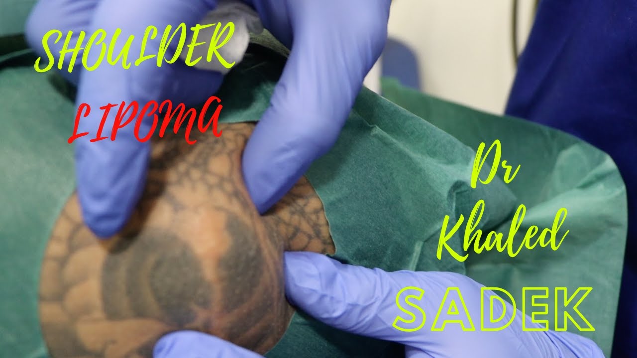 Massive Shoulder Lipoma. Minimal Scar. Dr Khaled Sadek. LipomaCyst.com ...