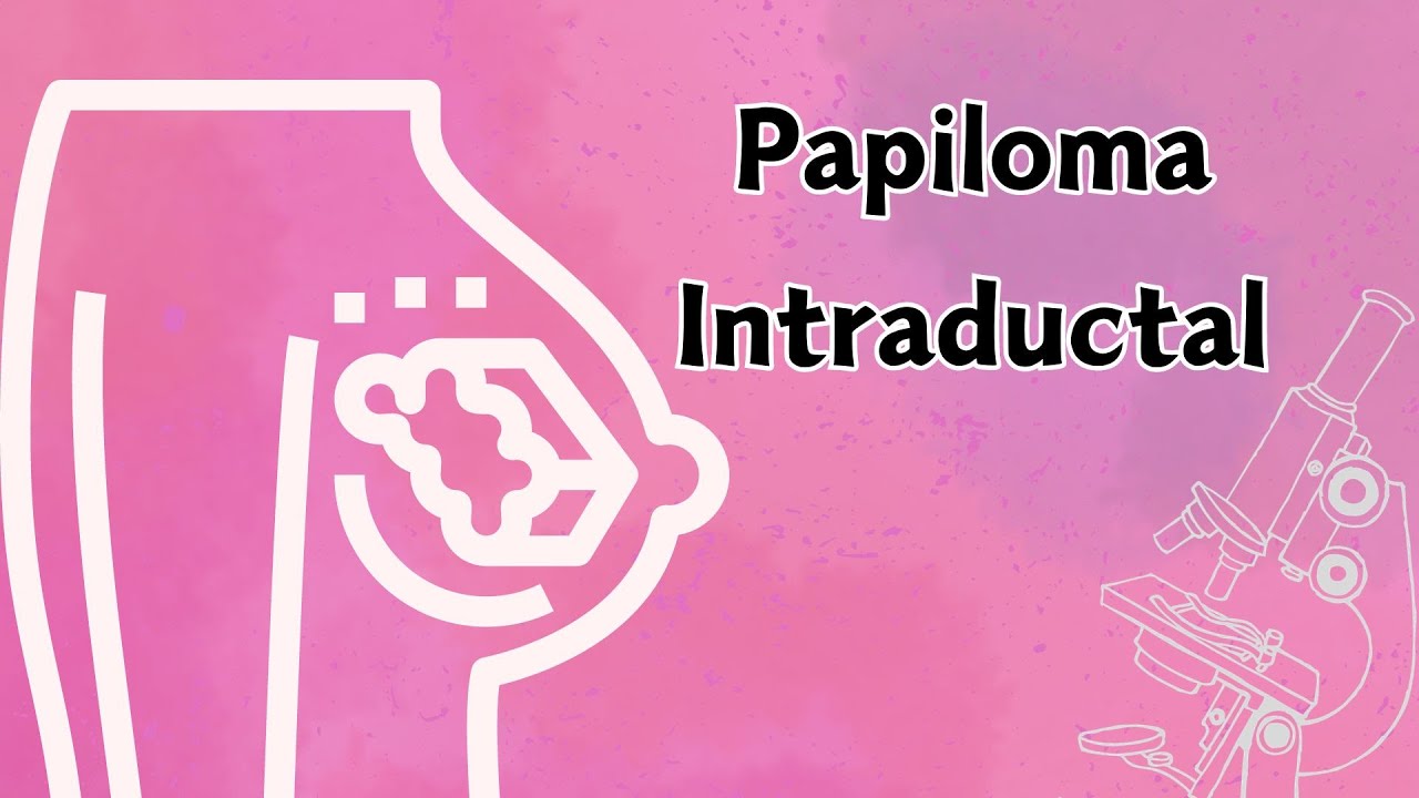 Papiloma Intraductal. Patología mamaria - YouTube