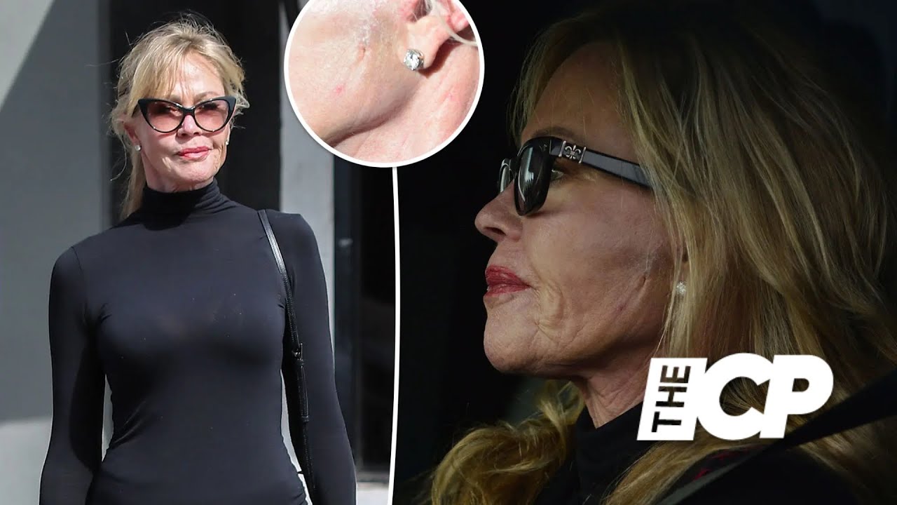 Melanie Griffith seen with new scar on her face after skin cancer ...