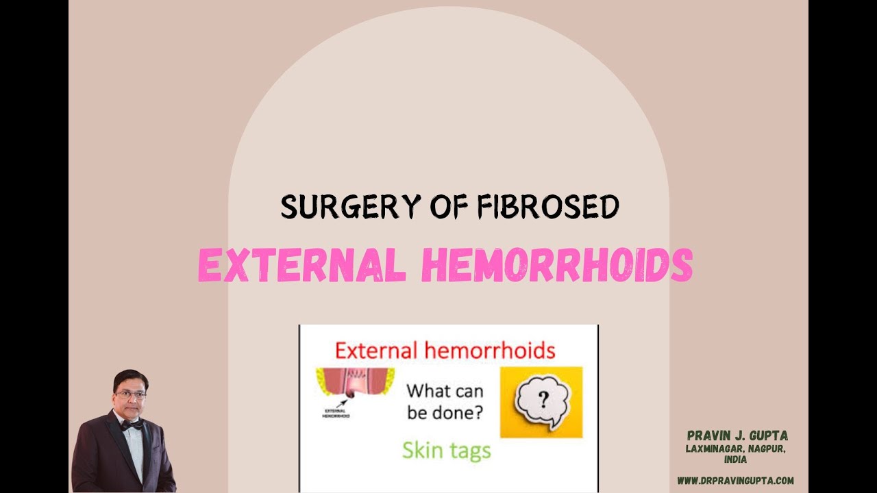 SURGERY OF FIBROSED EXTERNAL PILES - YouTube