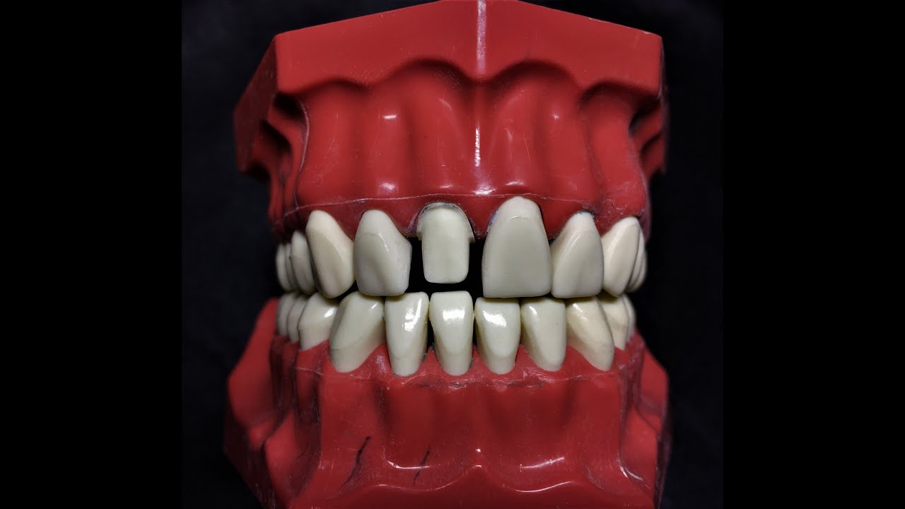 Fantom Çene Maksiller Santral Diş Preparasyonu - Phantom Jaw Upper ...