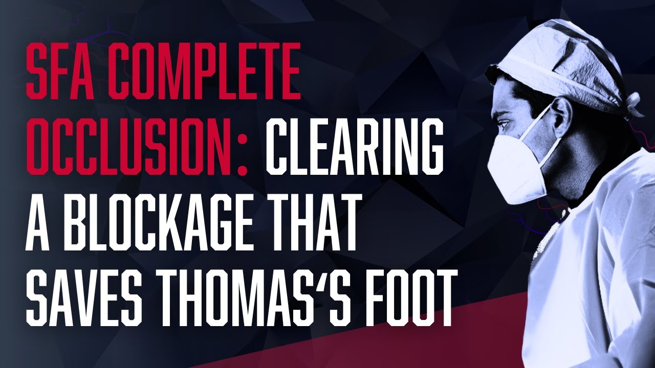 SFA Complete Occlusion: Clearing a Blockage that Saves Thomas‘s Foot ...