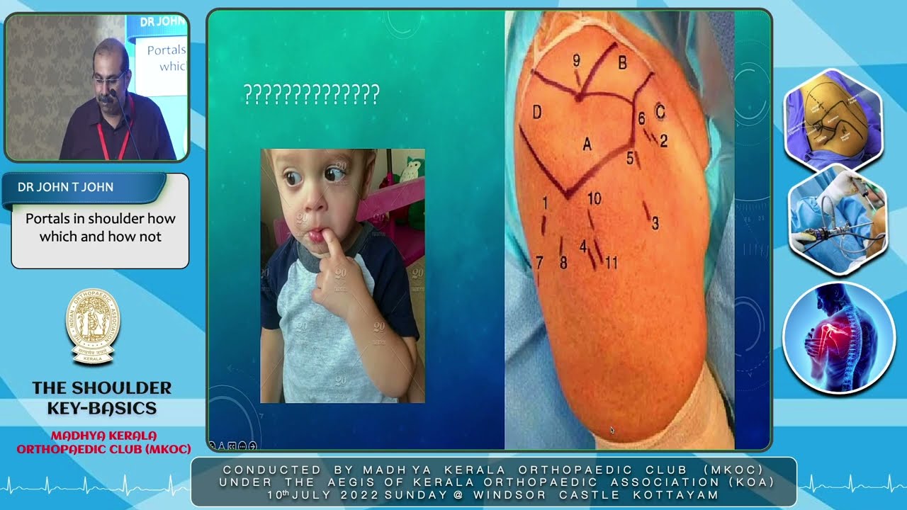Portals in Shoulder Arthroscopy HOW, WHICH & HOW NOT, Advantage By Dr ...