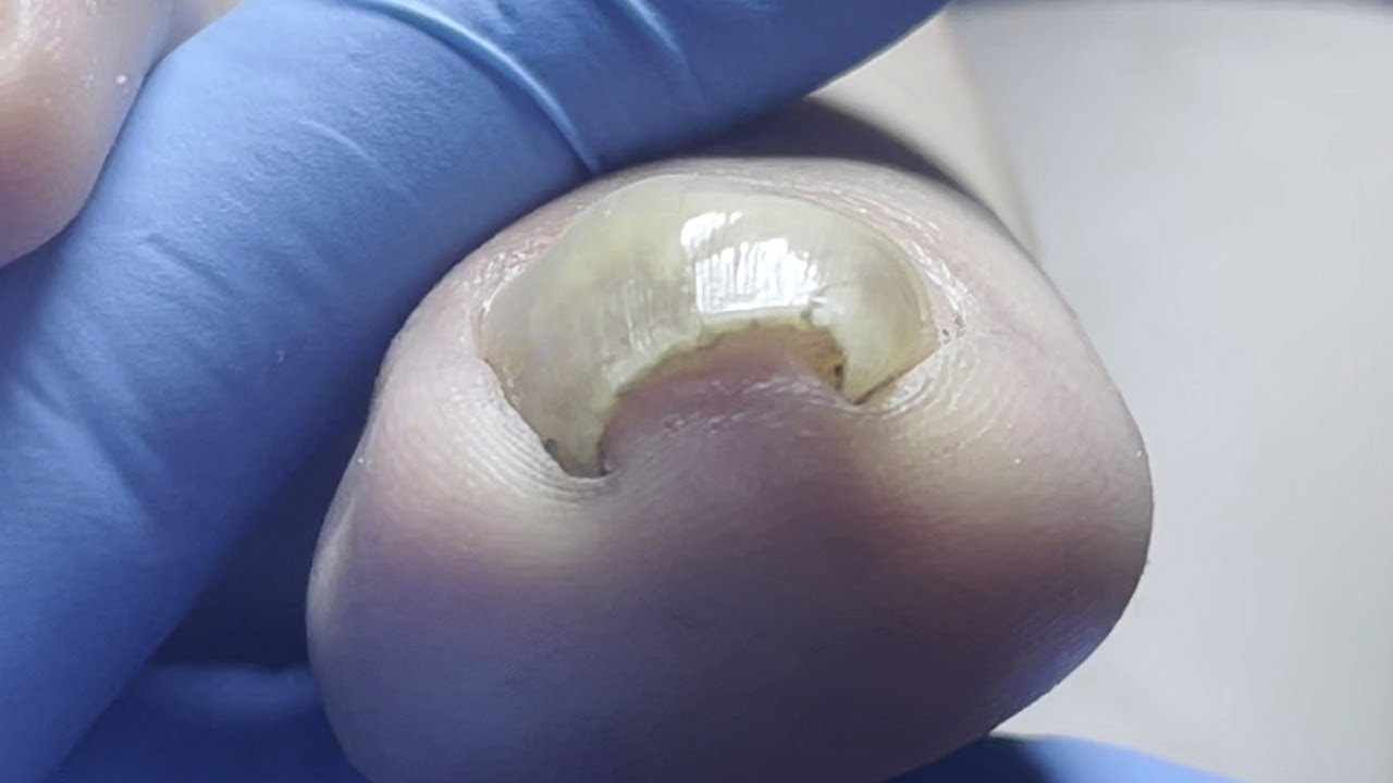 Super thick onychomycosis, remove nail fungus impurities - YouTube