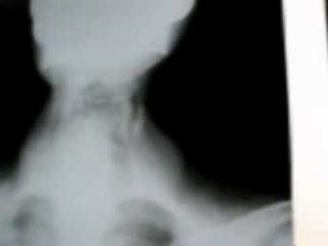 RX con desviacion de traquea - YouTube