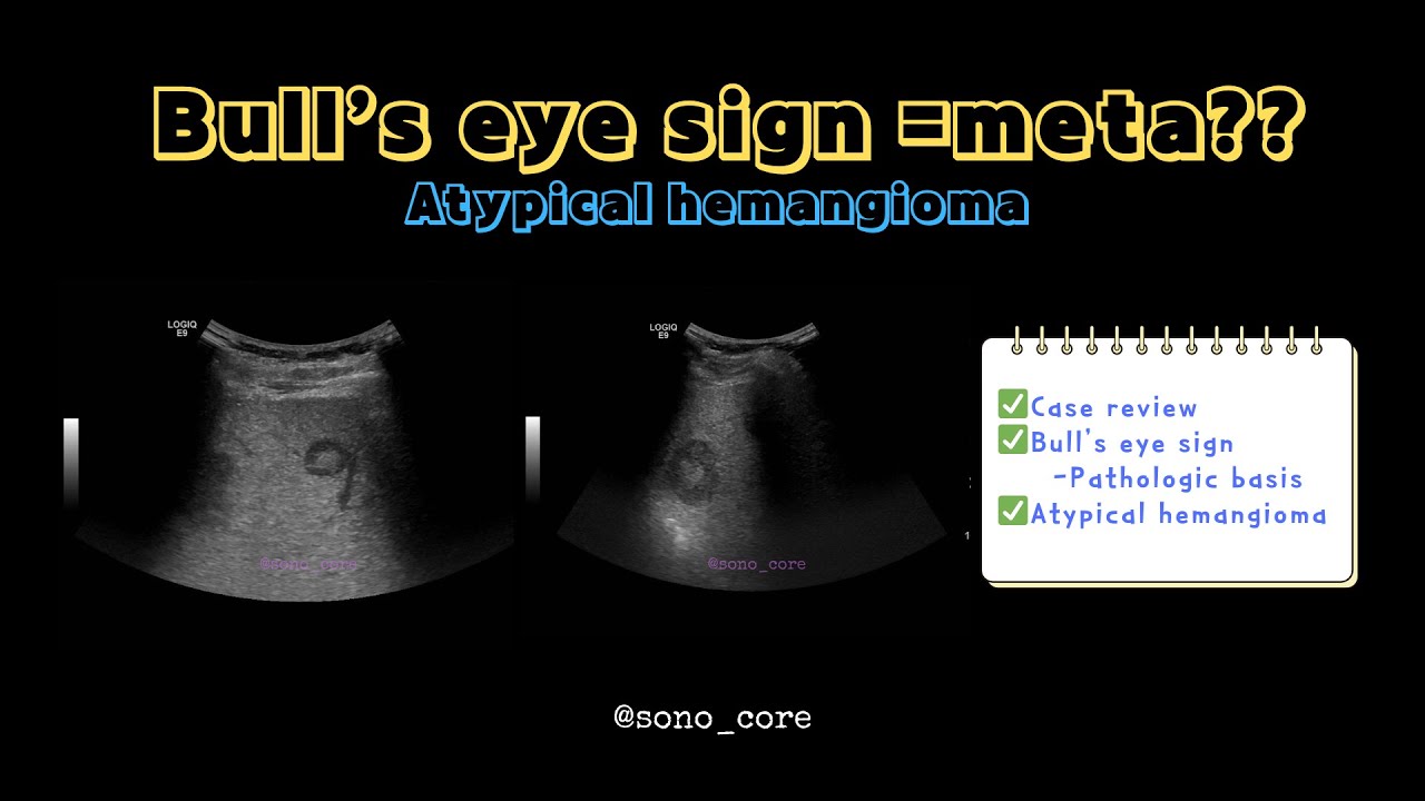 간초음파ㅣBull’s eye sign = meta?? 비전형적인 혈관종 - YouTube