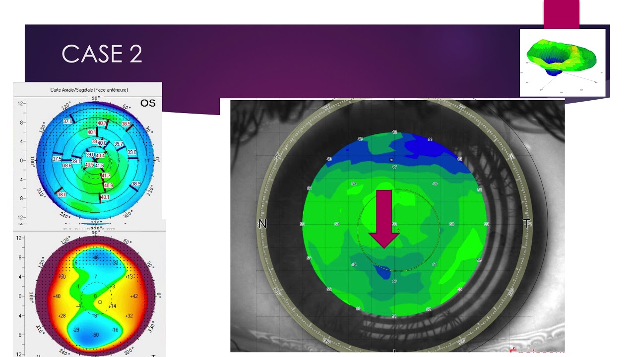 THE HELP OF EPITHELIAL MAPPING IN SUSPICIOUS CASES OF EARLY KERATOCONUS ...