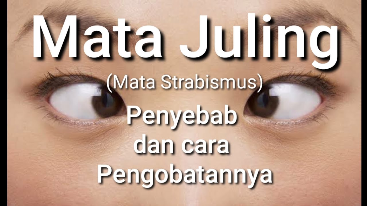 Mata Juling - Penyebab dan Cara Menyembuhkan nya - YouTube