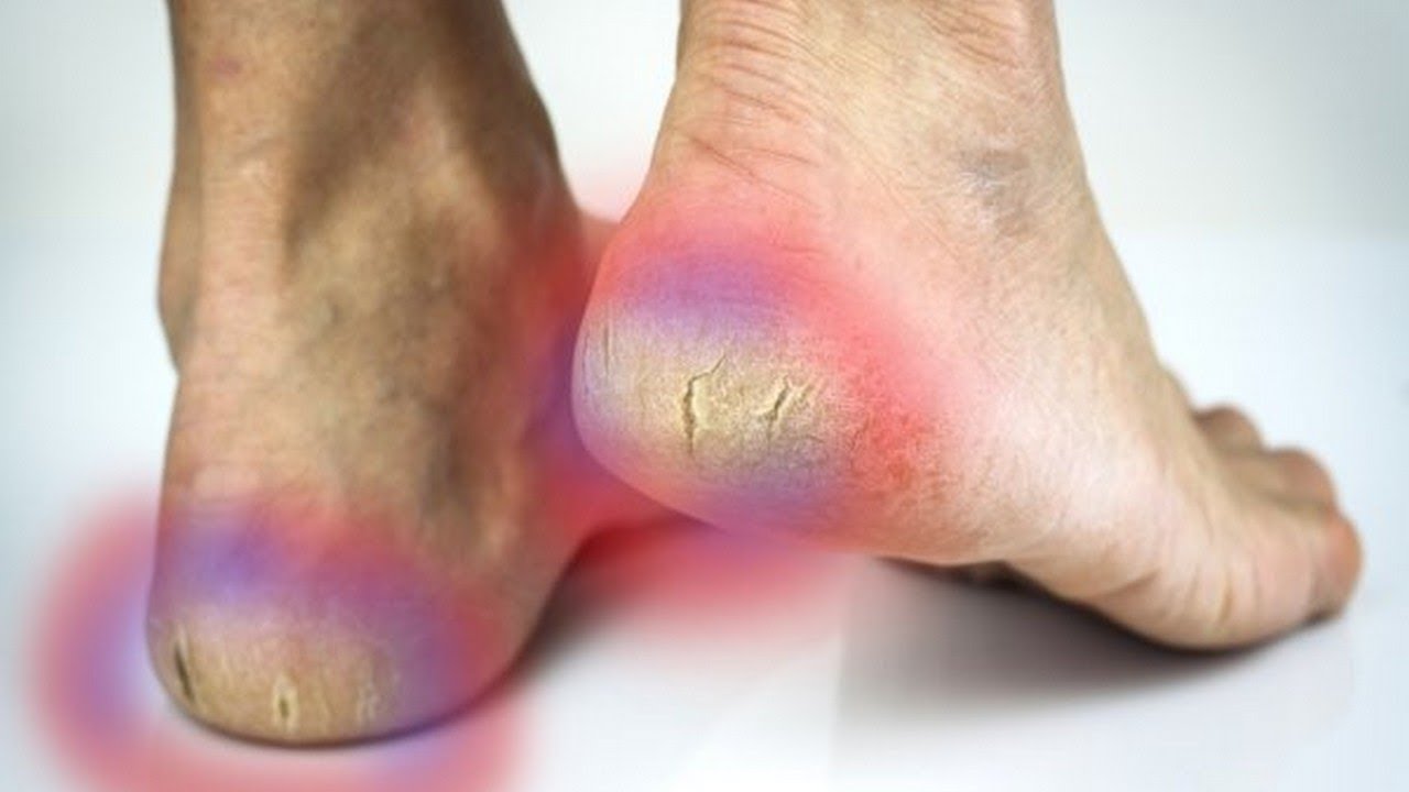 How to Get Rid of Calluses on Feet Overnight You Must Try This ...