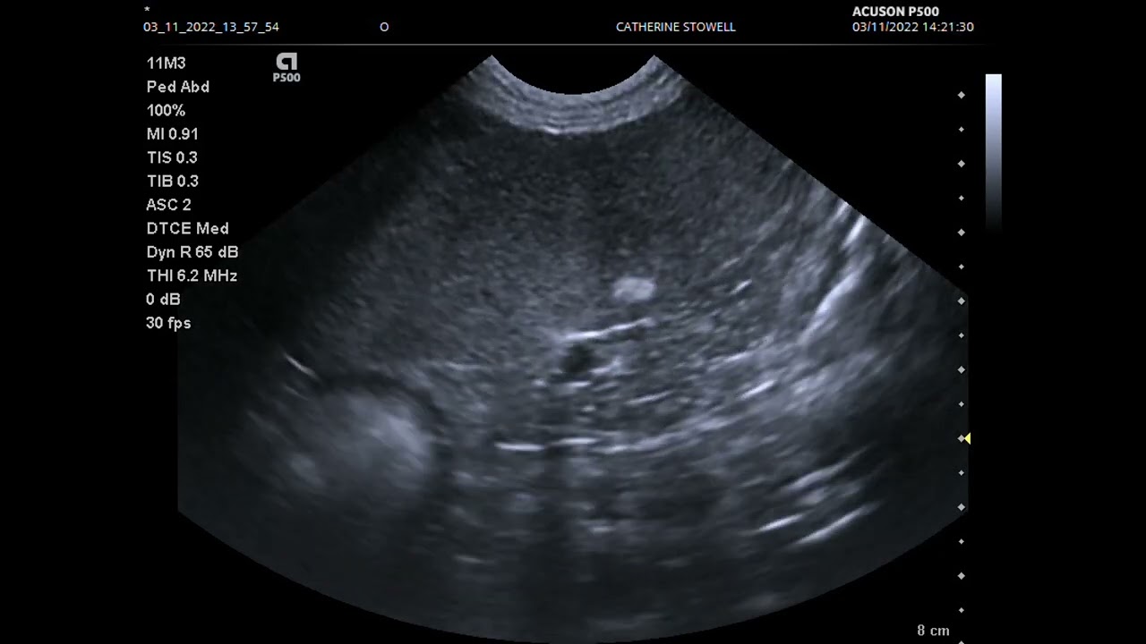 Ultrasound Scan Showing Calcified Nodule In The Canine Spleen YouTube Ultrasound Scan Showing Calcified Nodule In The Canine Spleen YouTube