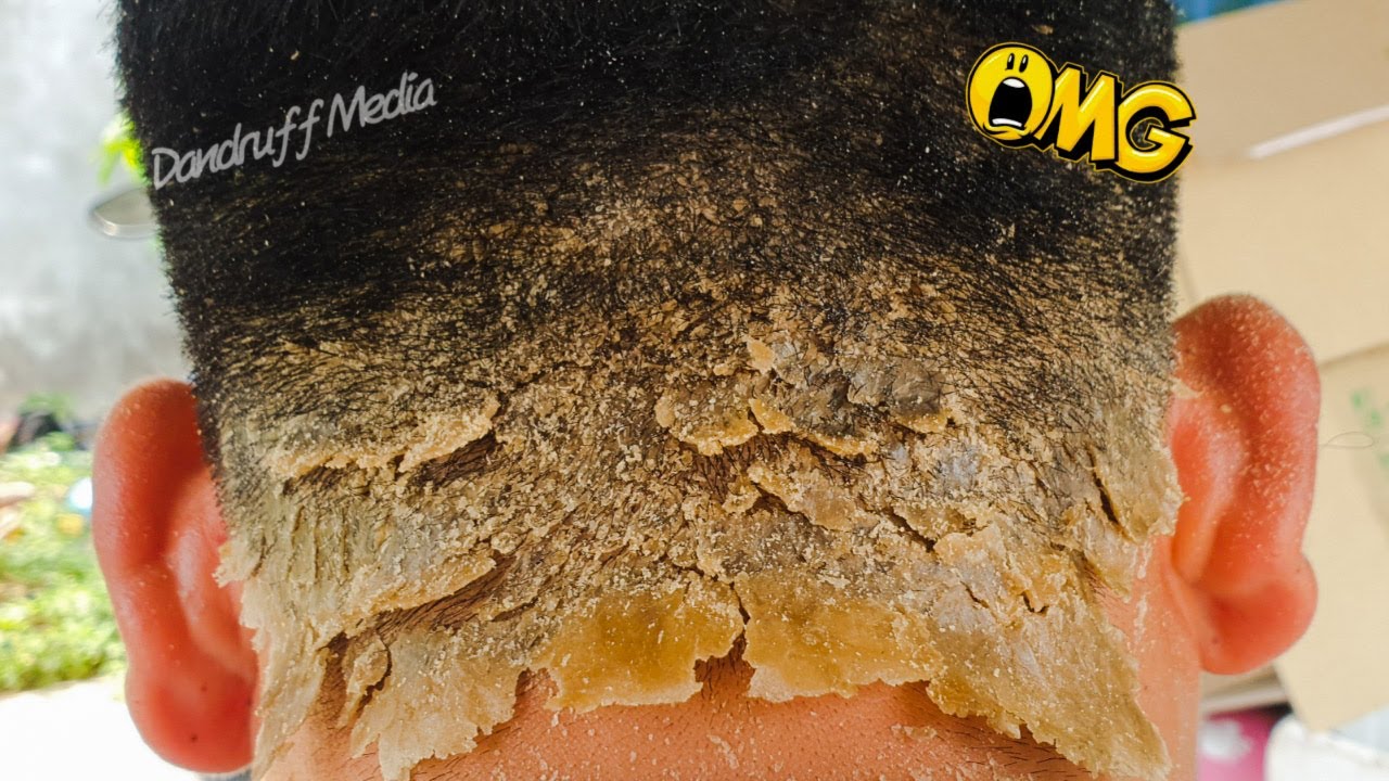 Psoriasis Scalp Removal Home Remedies !!Removal Big Flakes #235 - YouTube