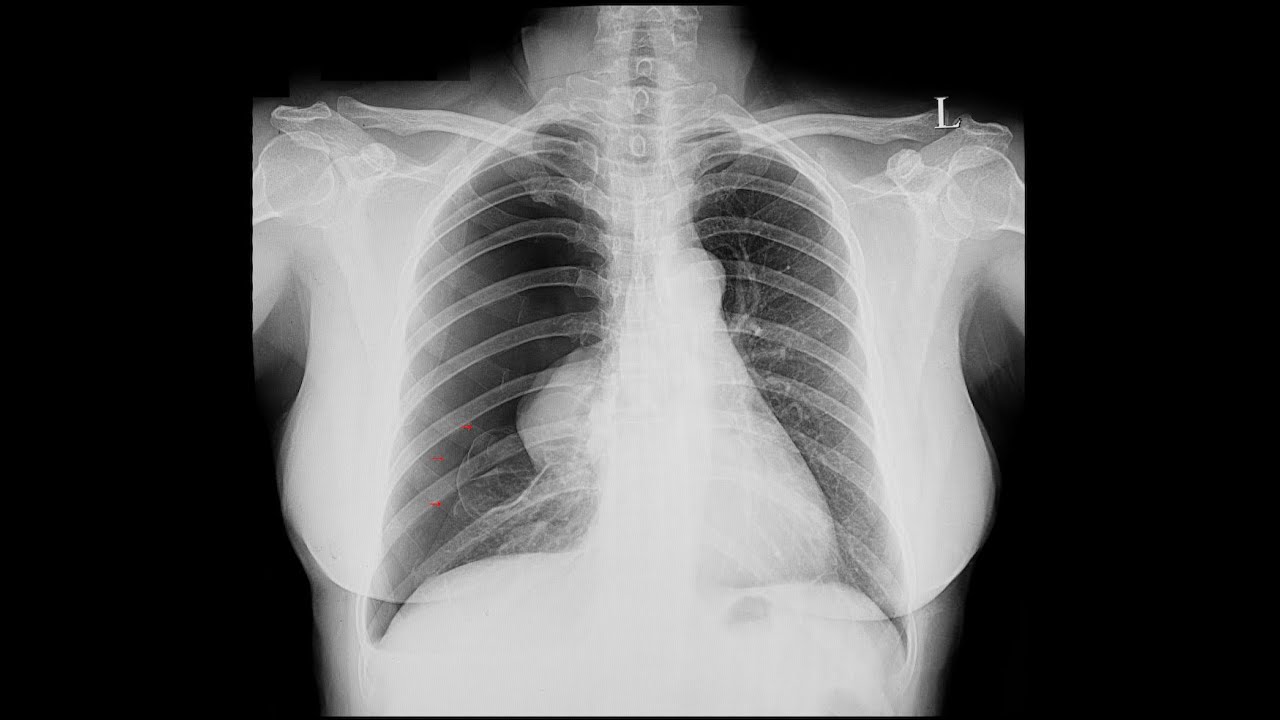 SGEM433: Simple Aspiration vs. Drainage for Complete Pneumothorax - YouTube