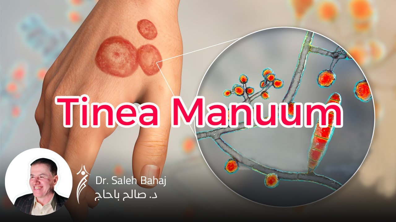 9. Tinea manuum - YouTube
