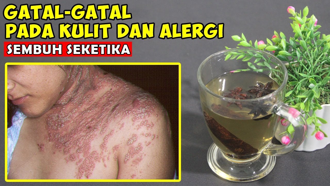 TAK PERLU OBAT MAHAL! SEGALA JENIS GATAL-GATAL SEMBUH SEKETIKA DENGAN ...