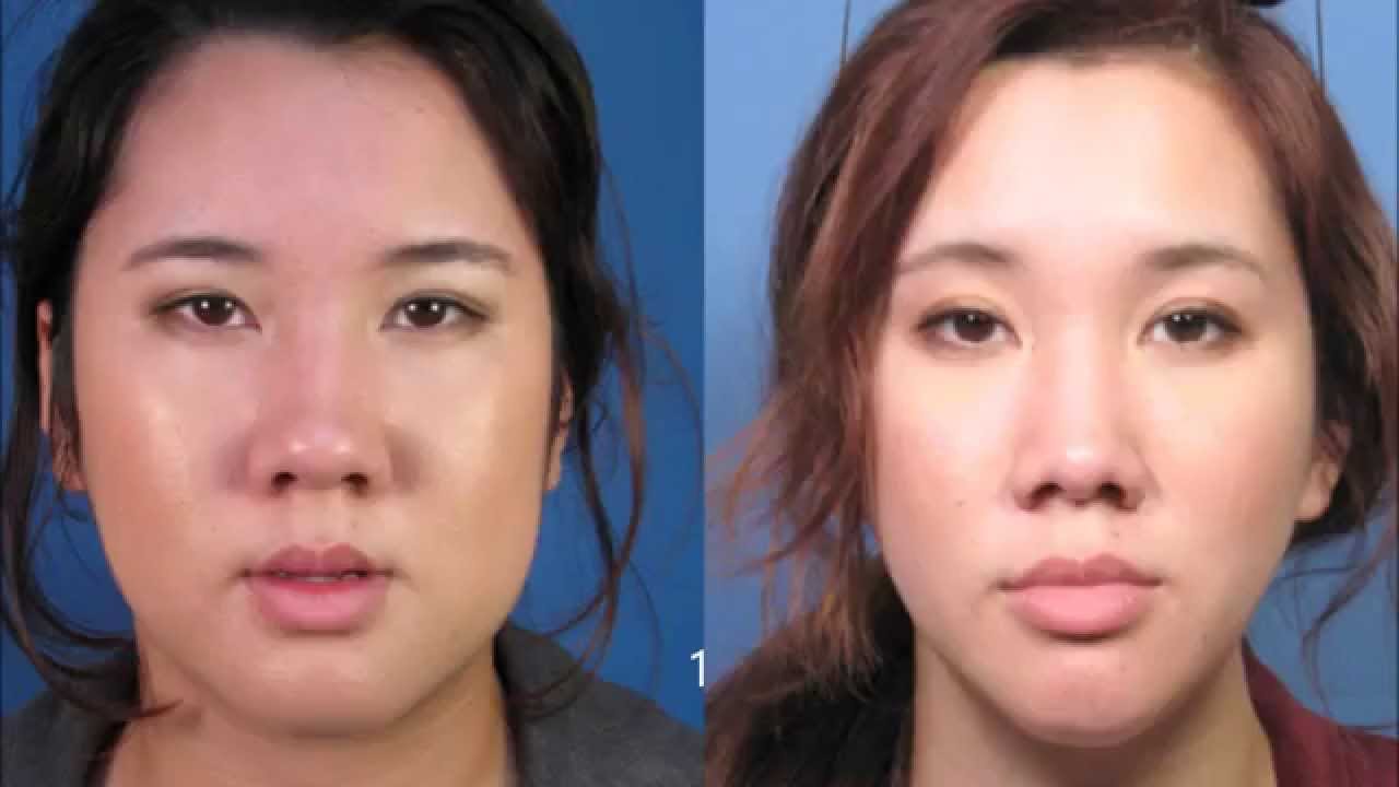 Botox in Thailand | Levira Clinic - YouTube