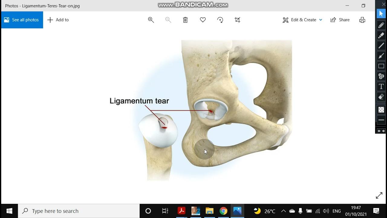 The 3 Intracapsular Ligaments Of The Hip Joint Youtube