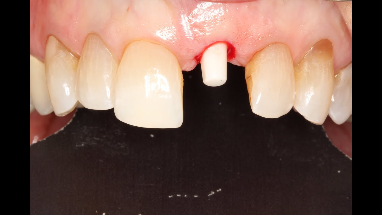 Placing a 1-piece Z Systems Zirkolith Implant - YouTube